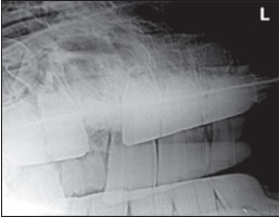 Equine Dentistry School | Case Study | Fractured upper 1st molars