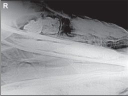 Equine Dentistry School | Case Study | Fractured upper 1st molars